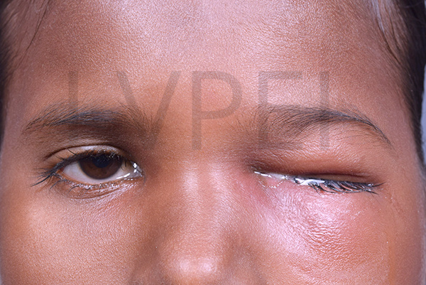 Infection of the tear drainage pathway of the eye – EyePlasty