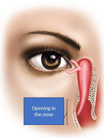 Infection of the tear drainage pathway of the eye – EyePlasty
